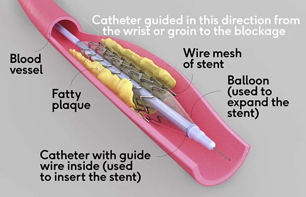 stent-inside-arterial-vessle-1 – A Kinesiological Approach